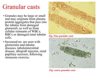 Granular Cast In Urine