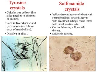 Tyrosine Crystals In Urine