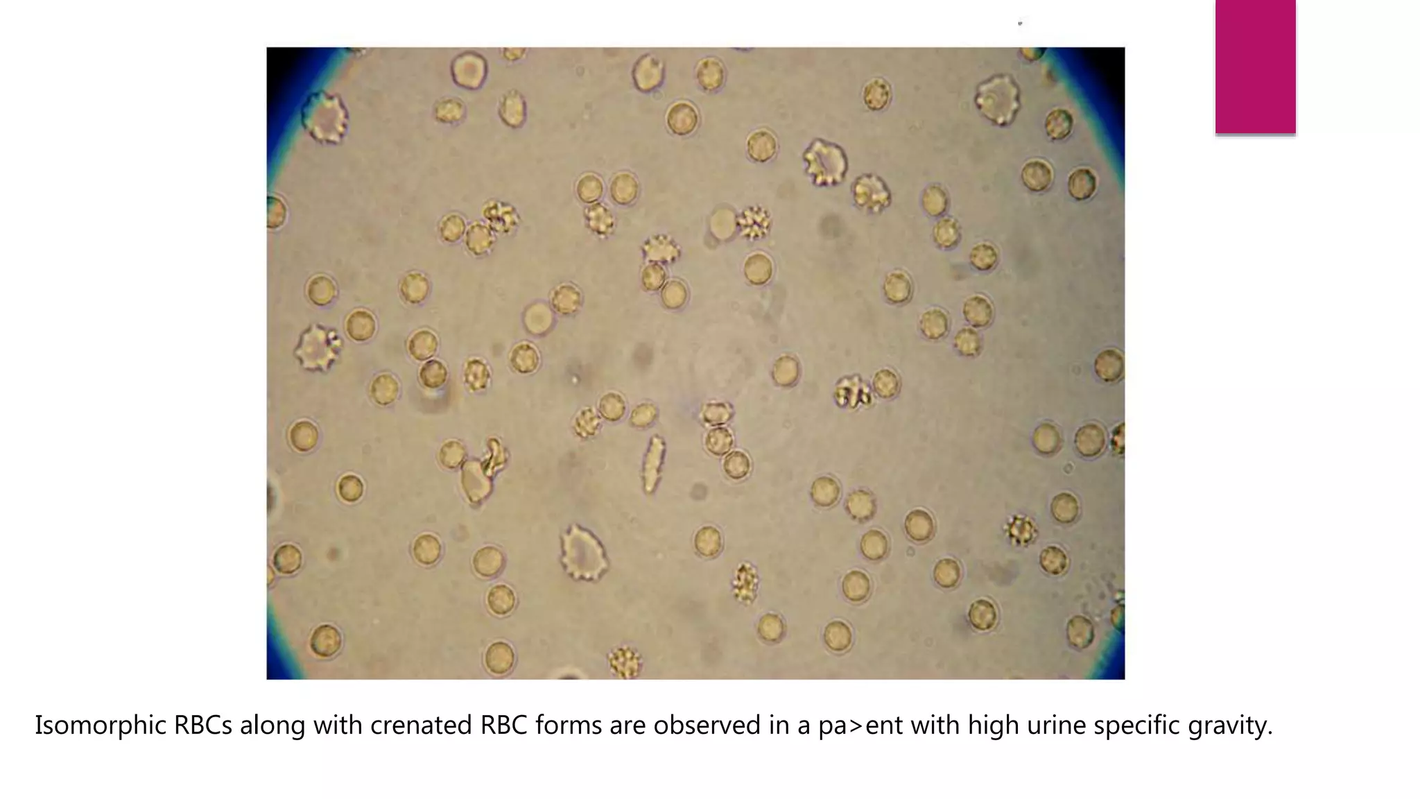 Urine sediment examination in the diagnosis and management | PPTX