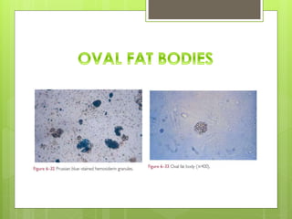 Oval Fat Bodies Urine Protein
