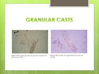Coarse Granular Cast In Urine