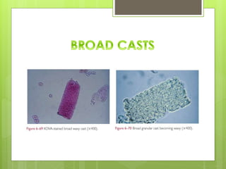 Broad Casts In Urine