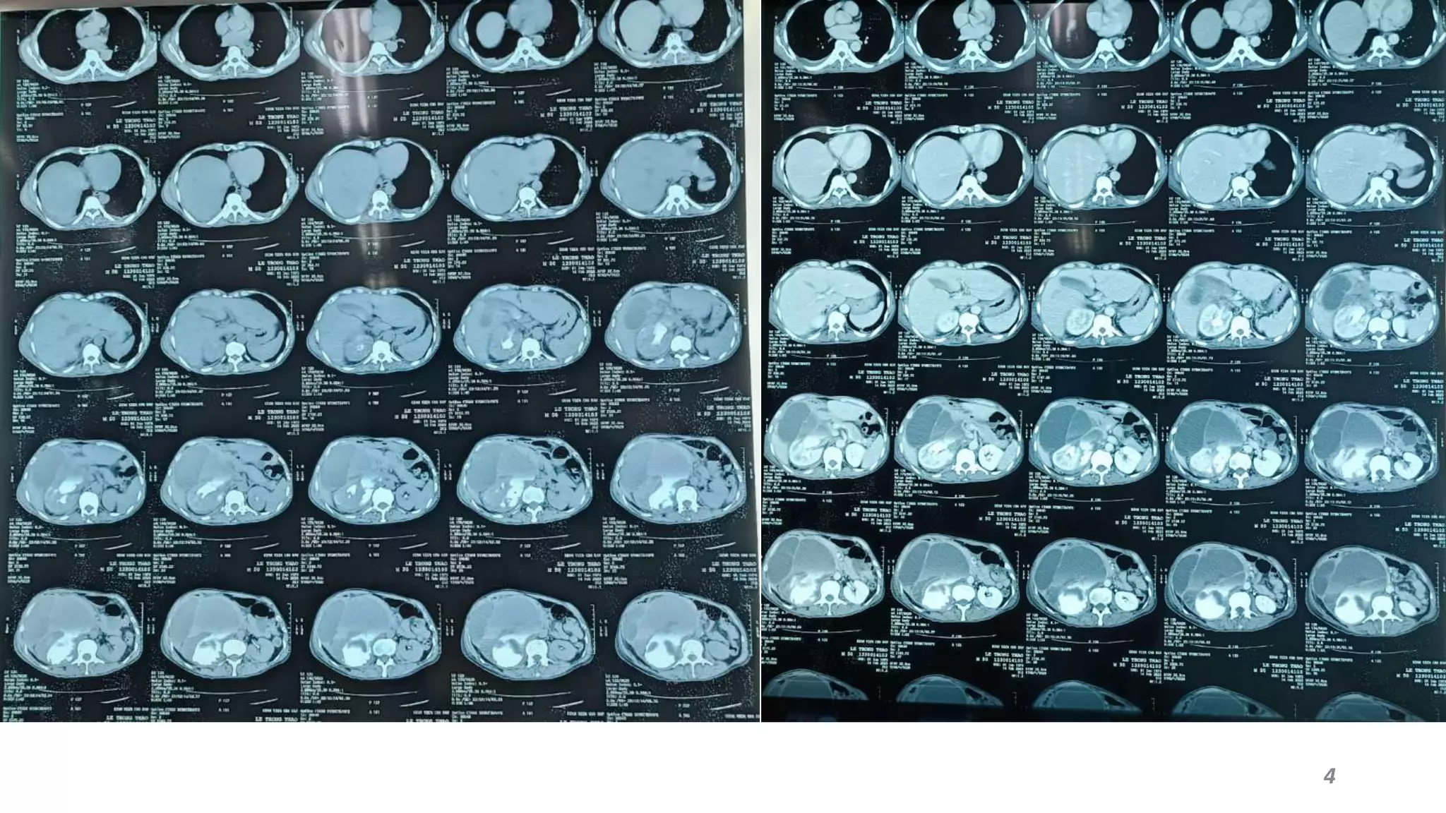Urinoma after renal trauma (1).pptx