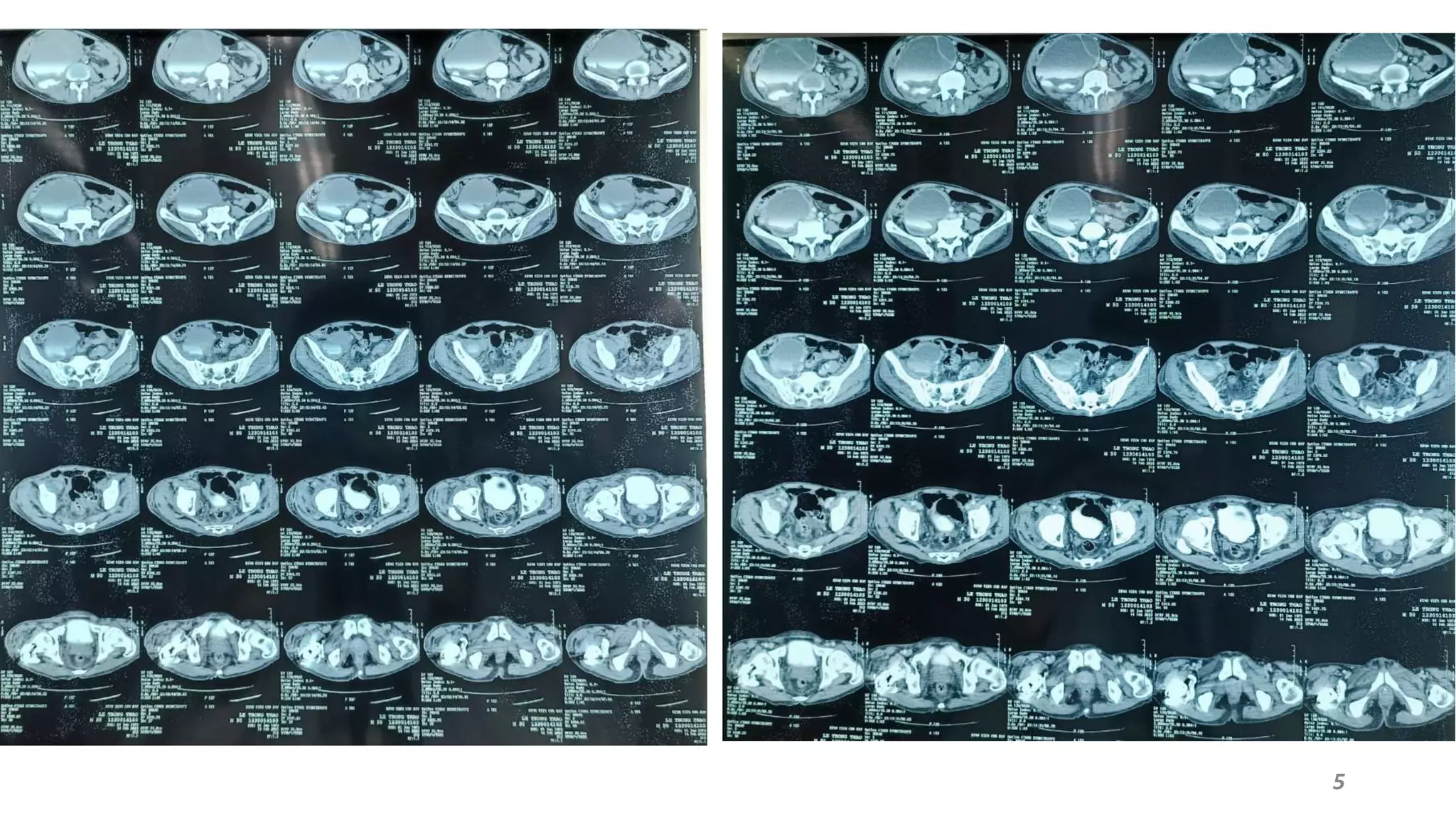 Urinoma after renal trauma (1).pptx