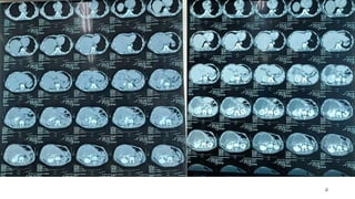 Urinoma after renal trauma (1).pptx