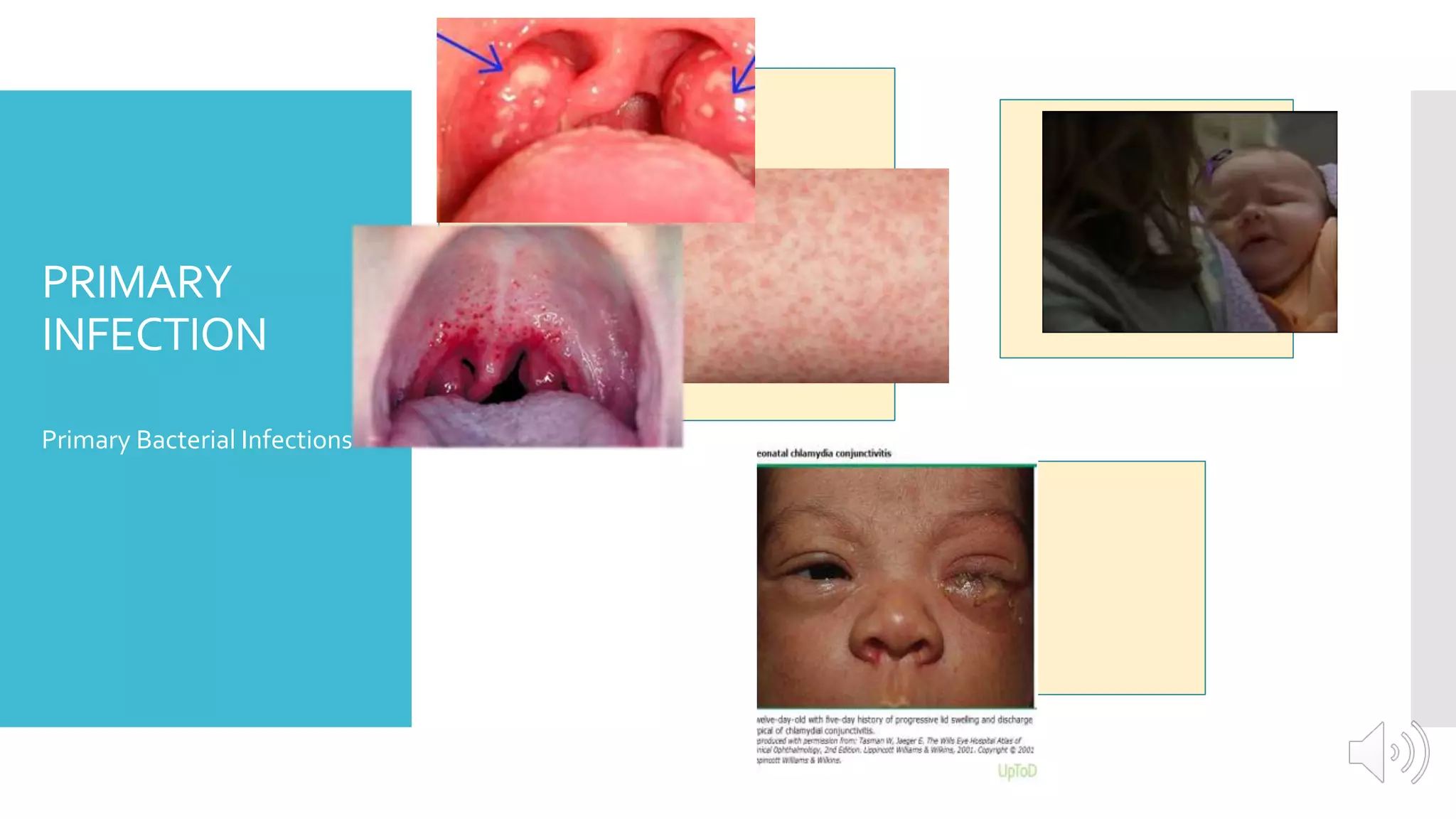 Approach to Pediatric Upper Respiratory Infections | PPSX
