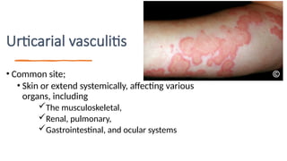 Uritericial vascuilitis updated lecturepptx | PPT