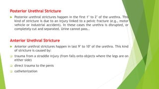 Urethral stricture | PPTX