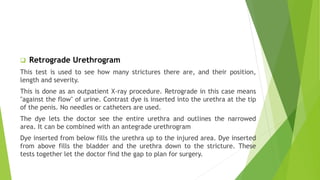 Urethral stricture | PPTX