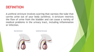 Urethral stricture | PPT | Free Download