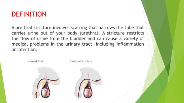 Urethral stricture | PPT