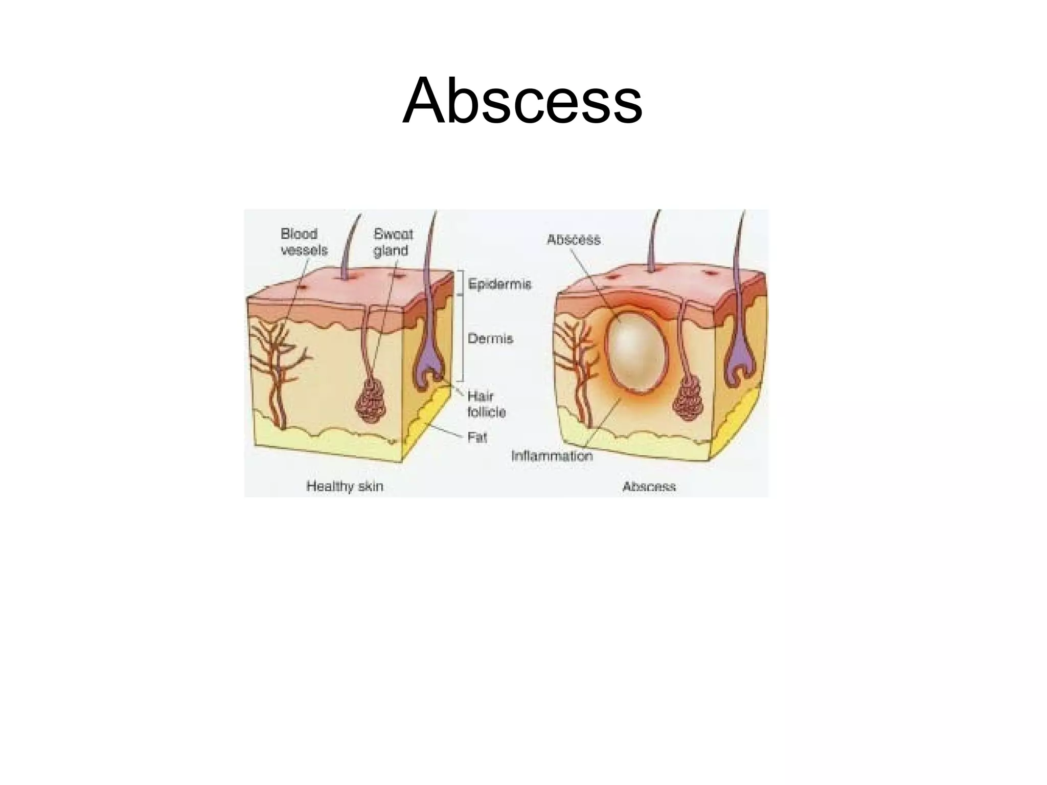 Abcess+incision+and+drainage | PPT | Ear, Nose and Throat Conditions ...