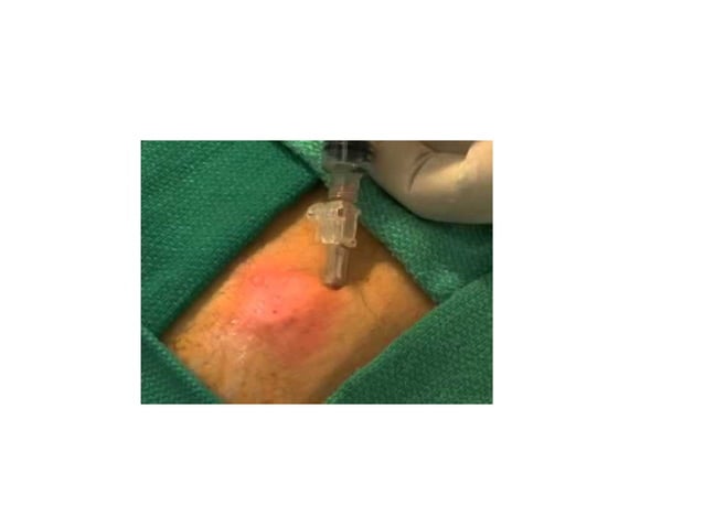 Abcess+incision+and+drainage | PPT | Ear, Nose and Throat Conditions ...