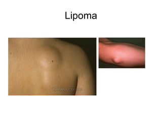 Abcess+incision+and+drainage | PPT