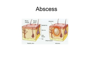 Skin Abscess Diagram
