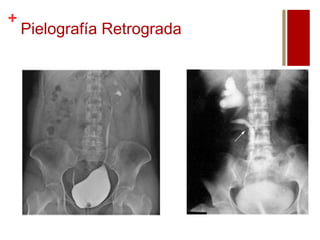 Uro Litiasis Pptx