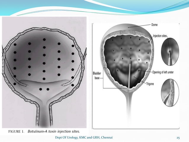 Uro gynacology- botox | PPT