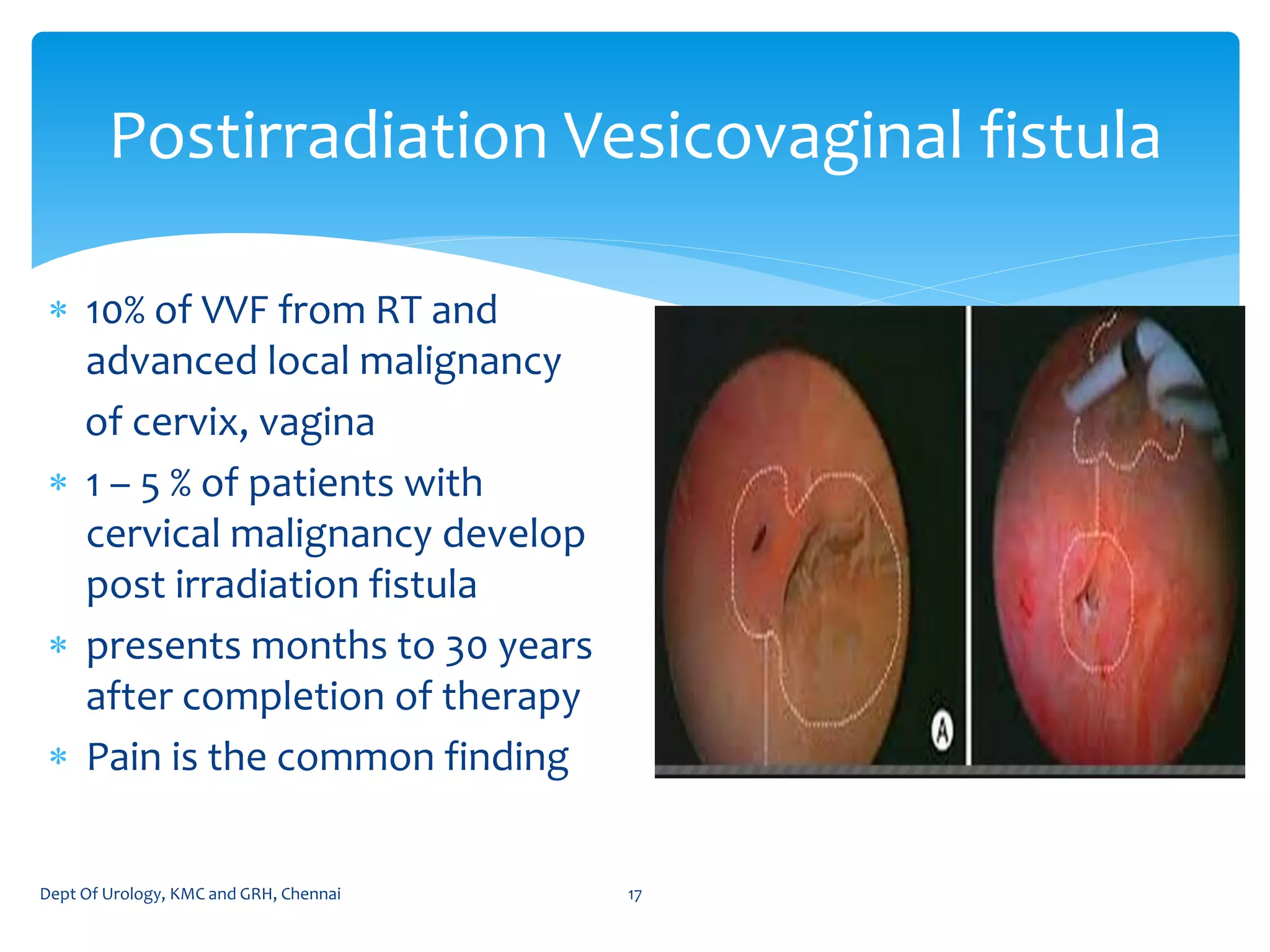 Uro gynacology- radiation f. | PPT