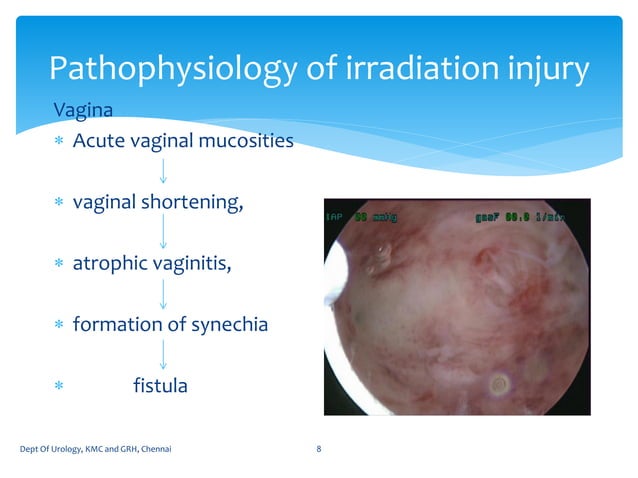 Uro gynacology- radiation f. | PPT