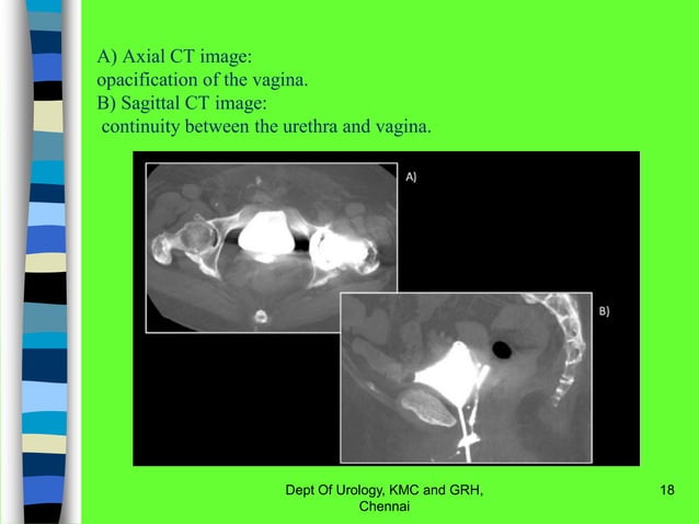 Uro gynacology- urethrovaginal f. | PPT