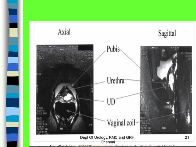 Uro gynacology- urethrovaginal f. | PPT