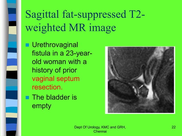 Uro gynacology- urethrovaginal f. | PPT