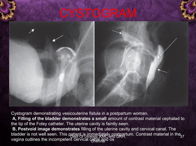 Uro gynacology- vef | PPT