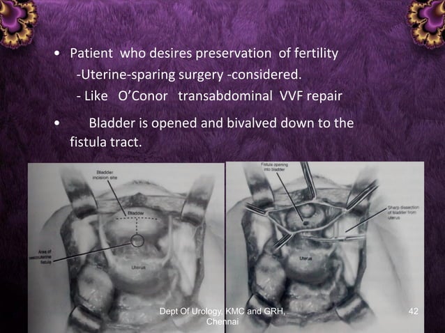 Uro gynacology- vef | PPT