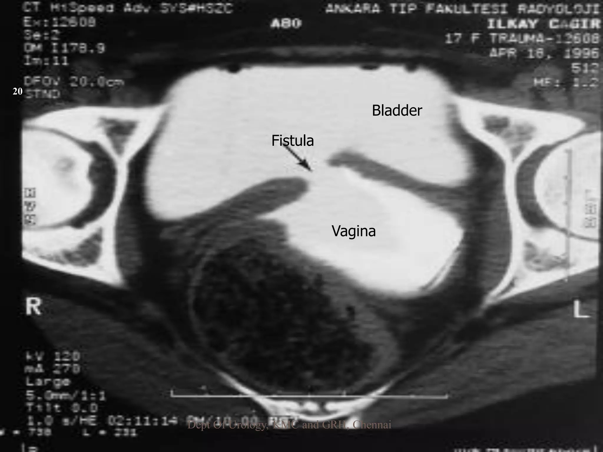 Uro gynacology- vvf | PDF