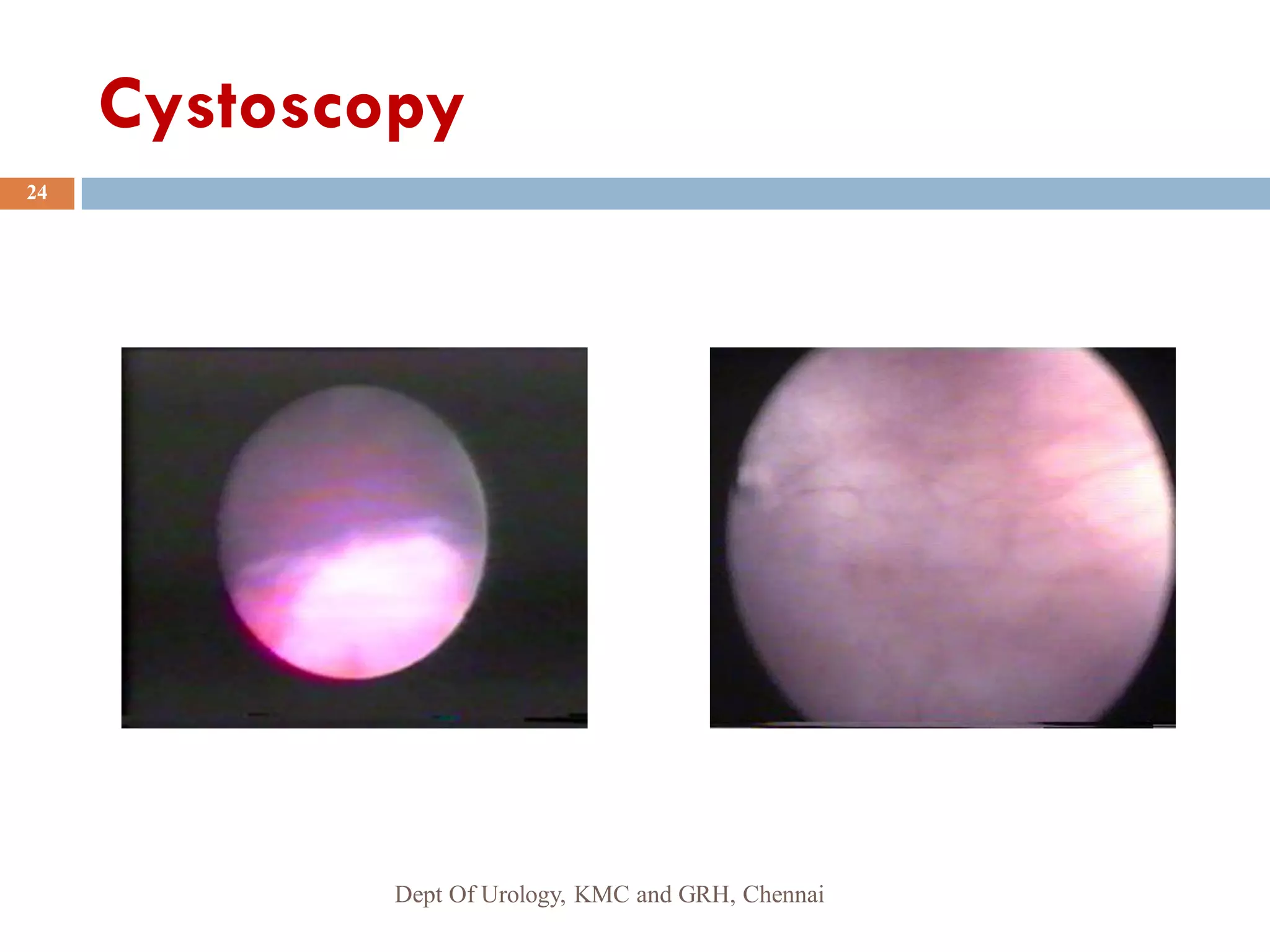 Uro gynacology- vvf | PDF