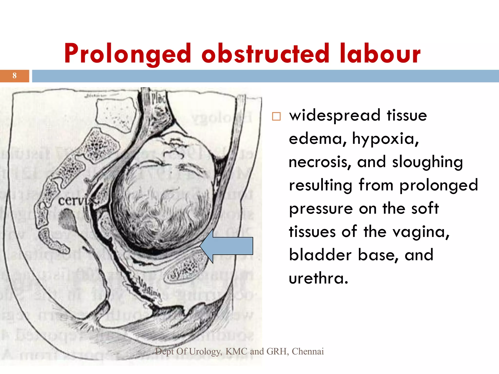 Uro gynacology- vvf | PDF