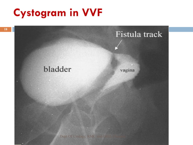 Uro gynacology- vvf | PDF | Sexual Conditions | Sexual Health