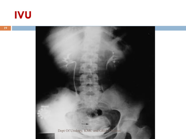 Uro gynacology- vvf | PDF | Sexual Conditions | Sexual Health