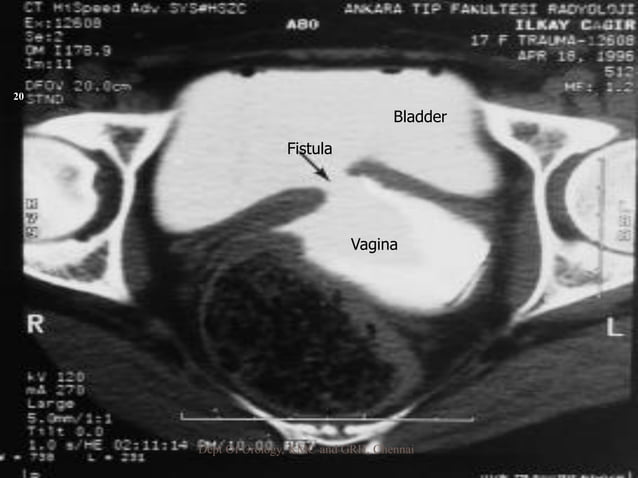 Uro gynacology- vvf | PDF | Sexual Conditions | Sexual Health