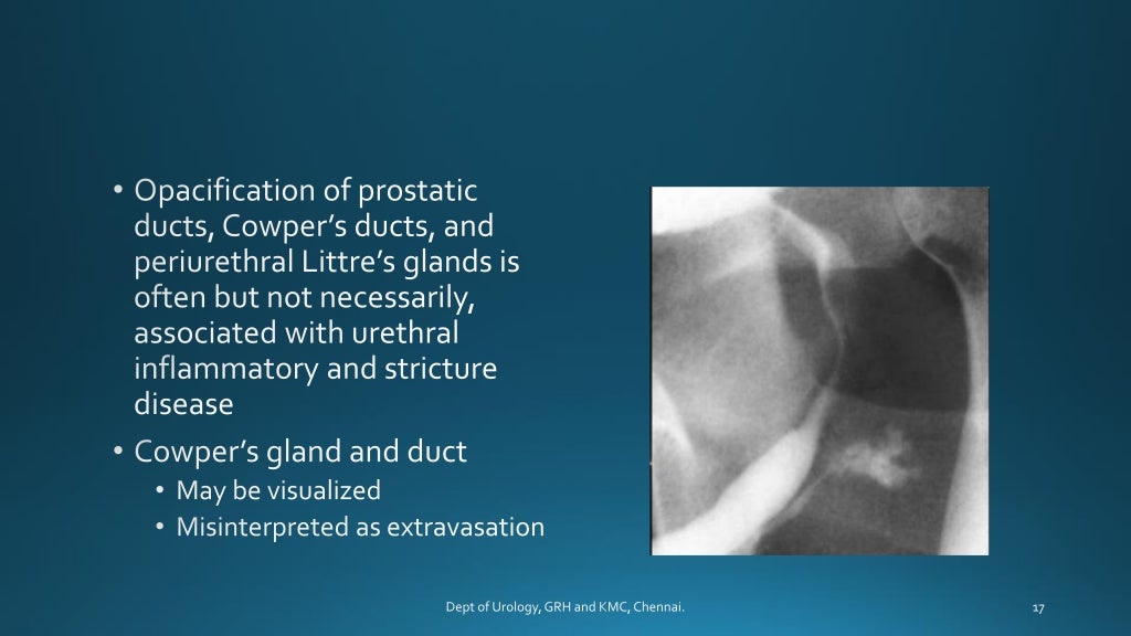 ANTEGRADE URETHROGRAM
