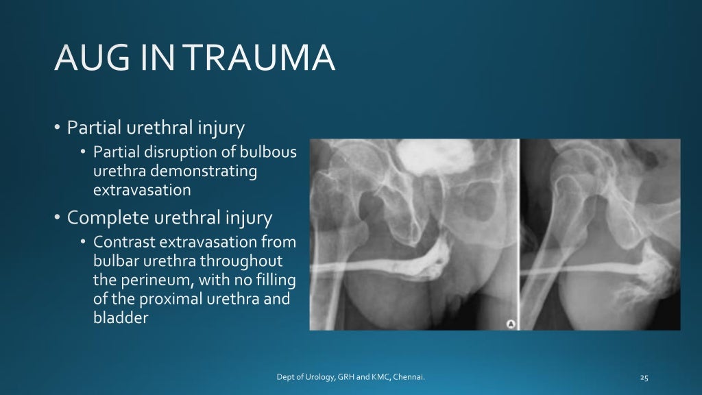 ANTEGRADE URETHROGRAM