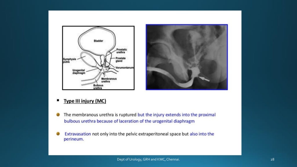 ANTEGRADE URETHROGRAM