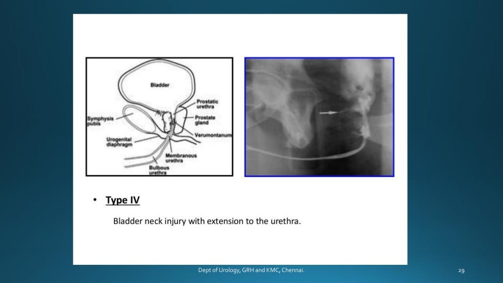 ANTEGRADE URETHROGRAM