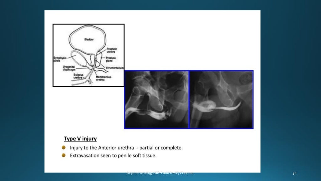 ANTEGRADE URETHROGRAM