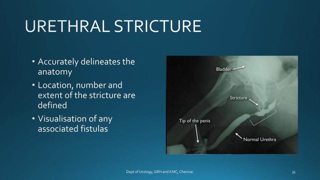 ANTEGRADE URETHROGRAM