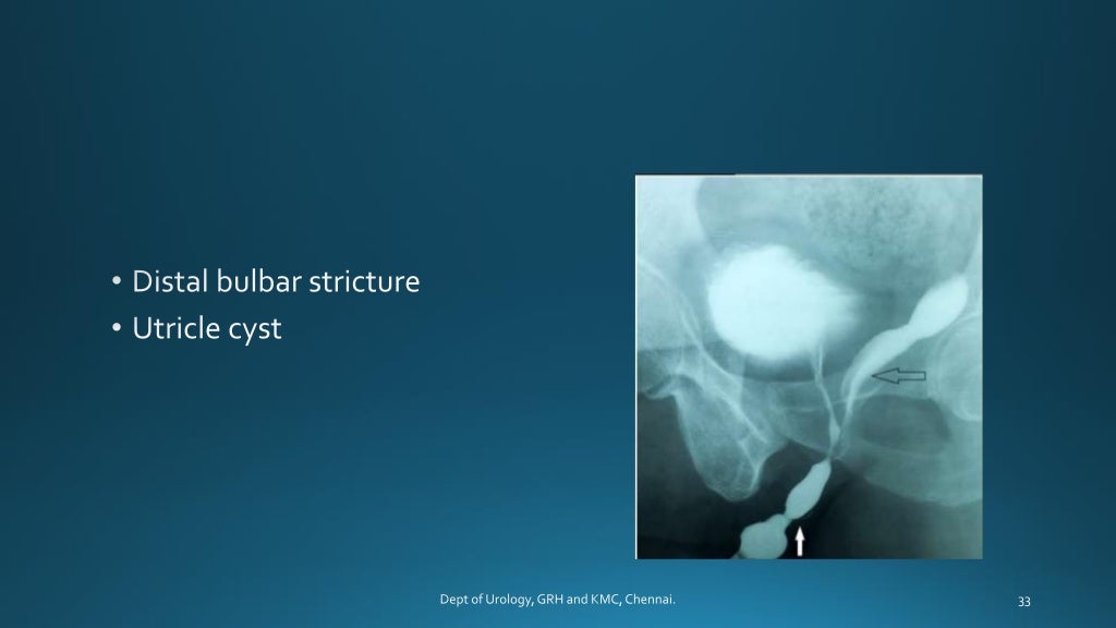 ANTEGRADE URETHROGRAM