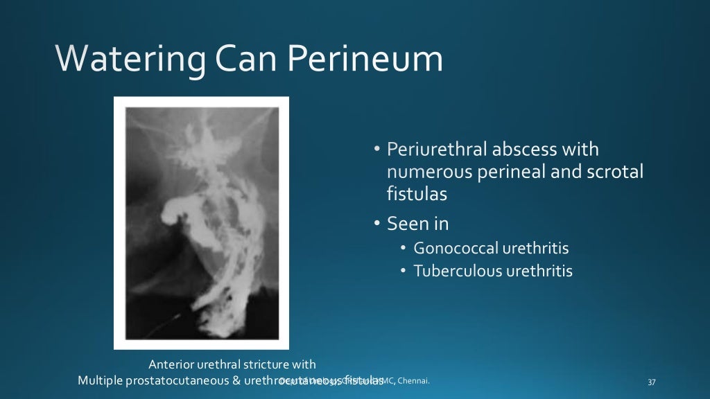 ANTEGRADE URETHROGRAM