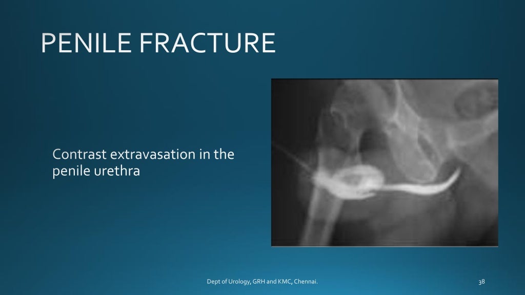 ANTEGRADE URETHROGRAM