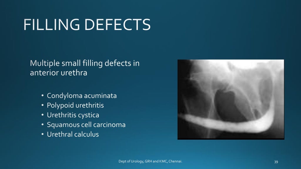 ANTEGRADE URETHROGRAM