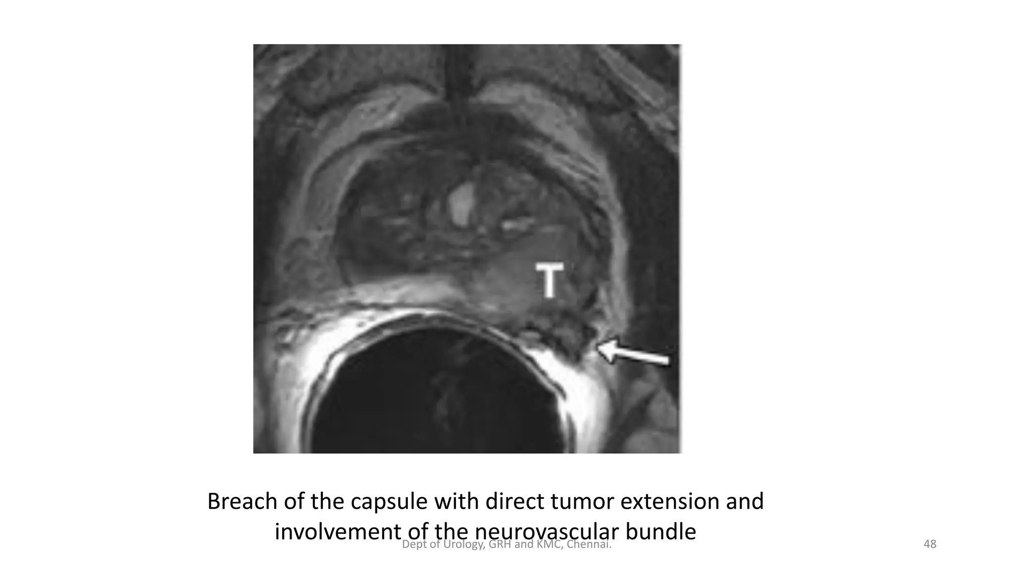 MRI IN UROLOGY | PDF