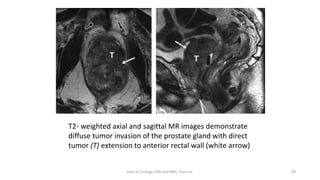 MRI IN UROLOGY | PDF