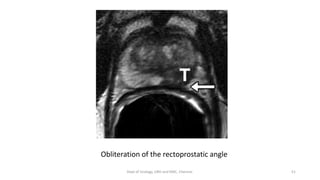 MRI IN UROLOGY | PDF