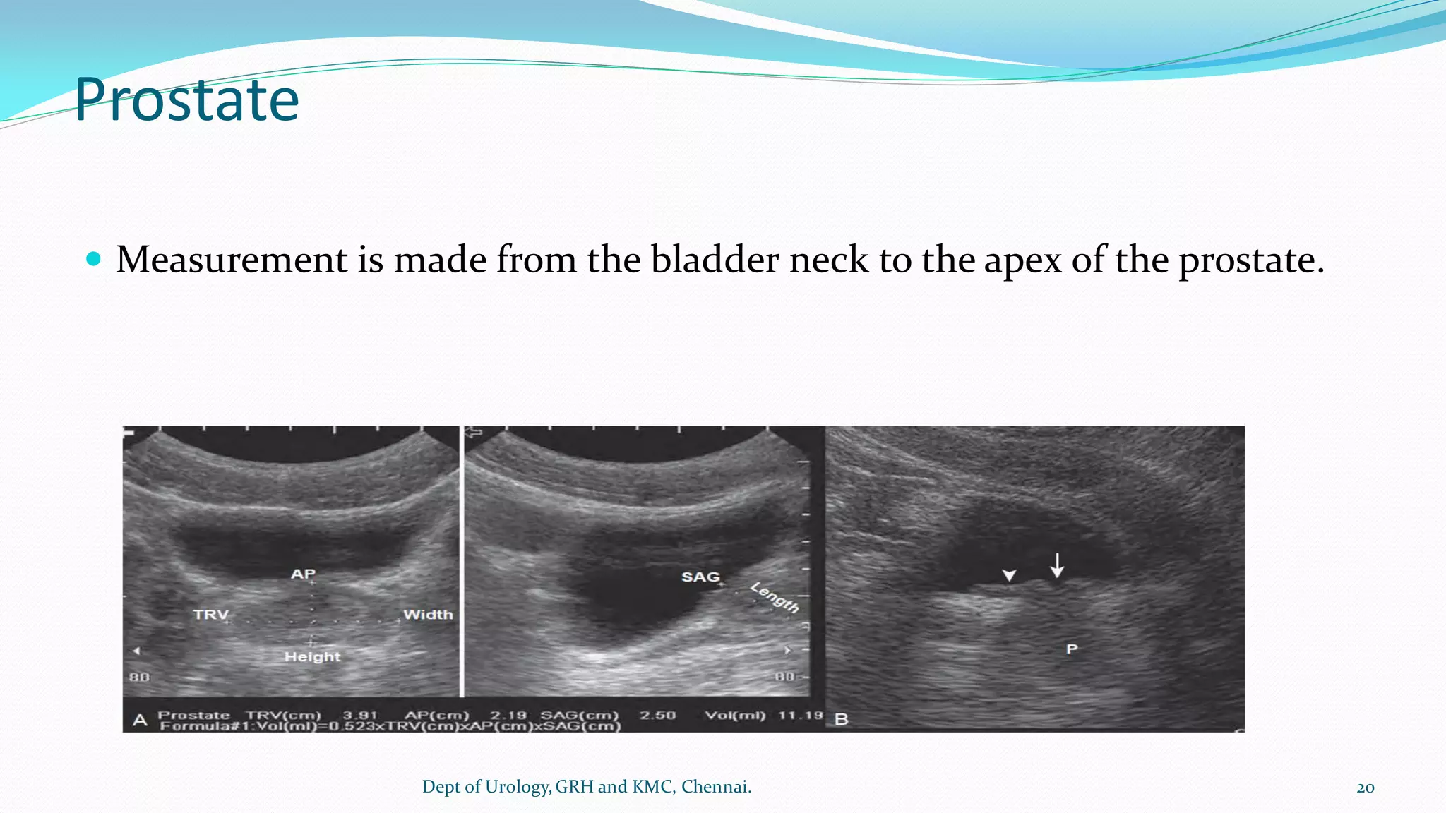 ULTRASOUND IN UROLOGY | PDF