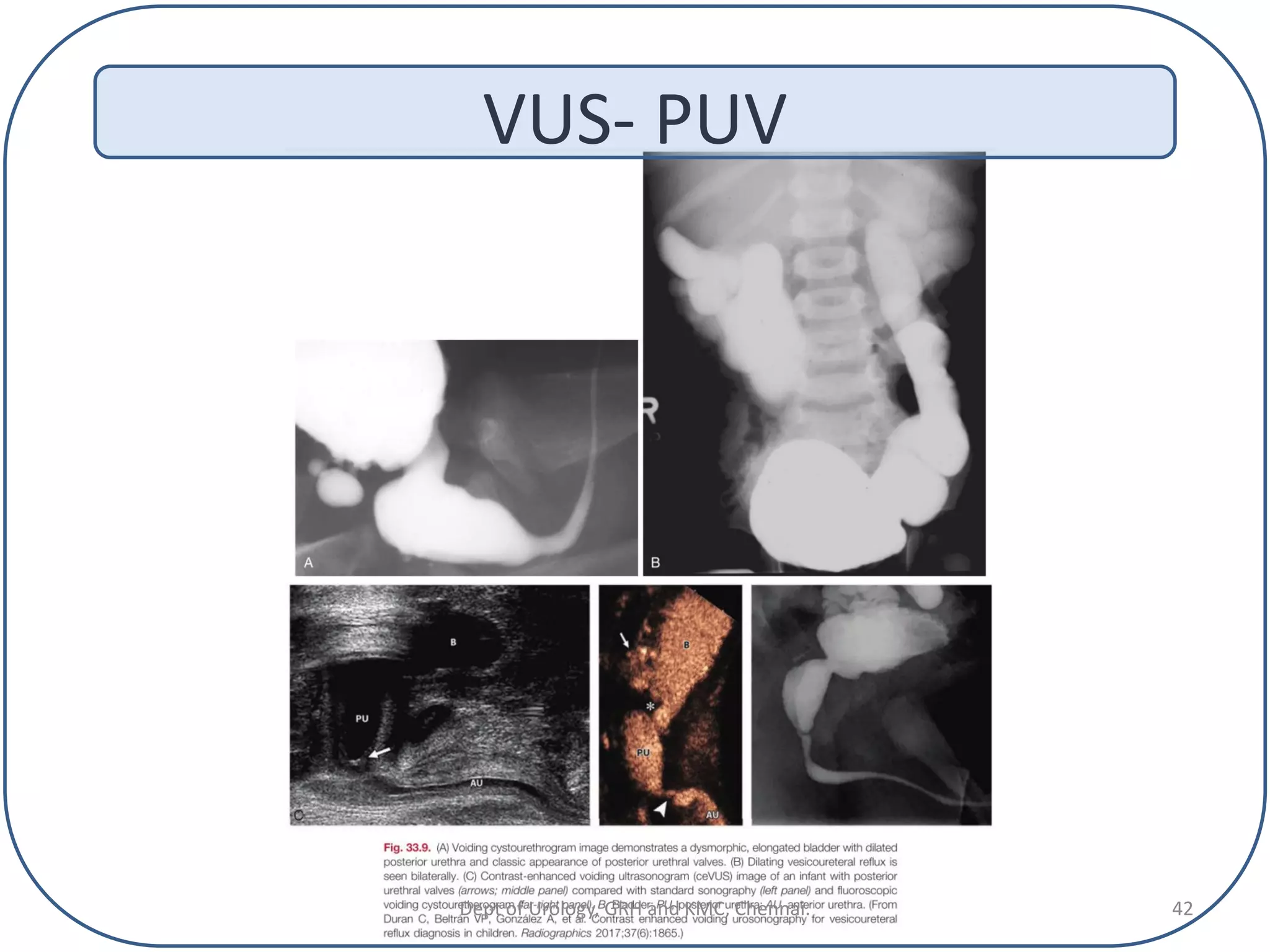 VOIDING CYSTO URETHROGRAM | PDF