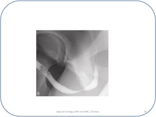 VOIDING CYSTO URETHROGRAM | PDF